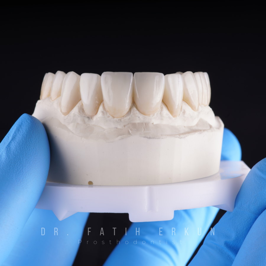 Veneer and Crown: What’s the difference? - Dental Excellence Turkey