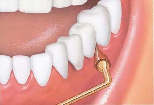 How to Protect Your Teeth from Decay? - Dental Excellence Turkey Blog